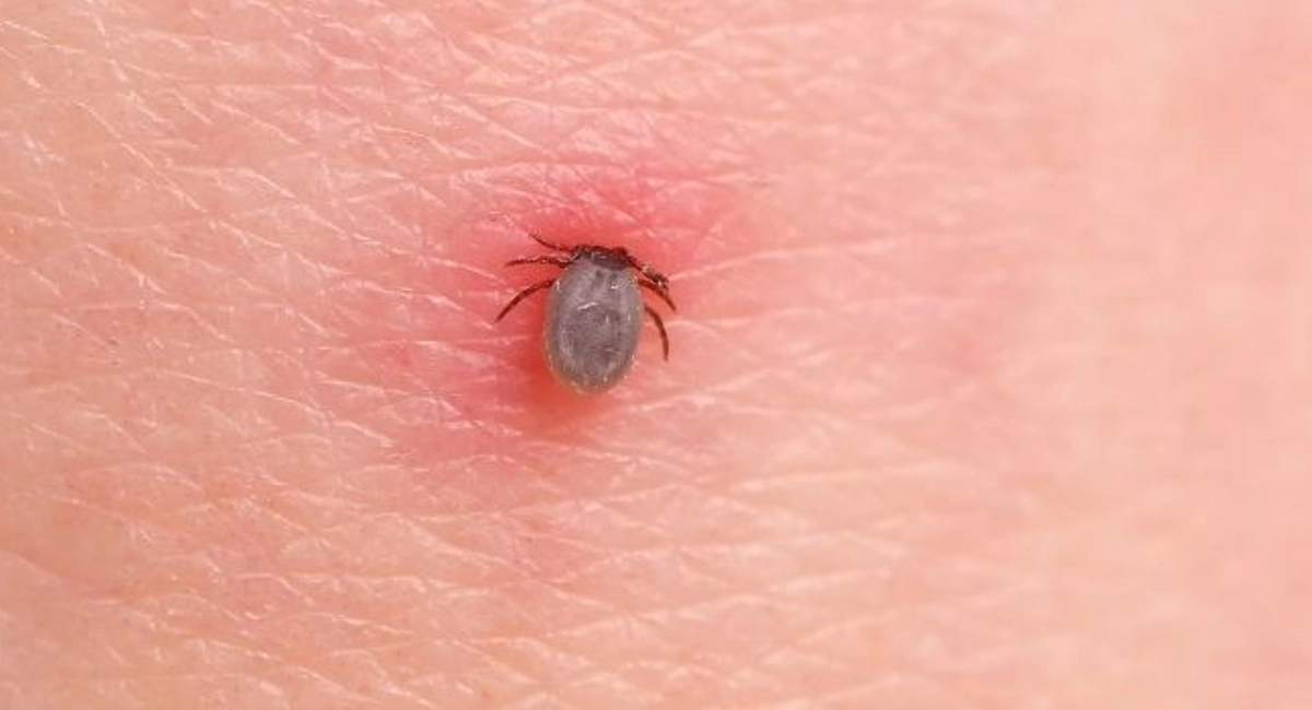 Top 5 Western cities for Lyme disease | Western Exterminator